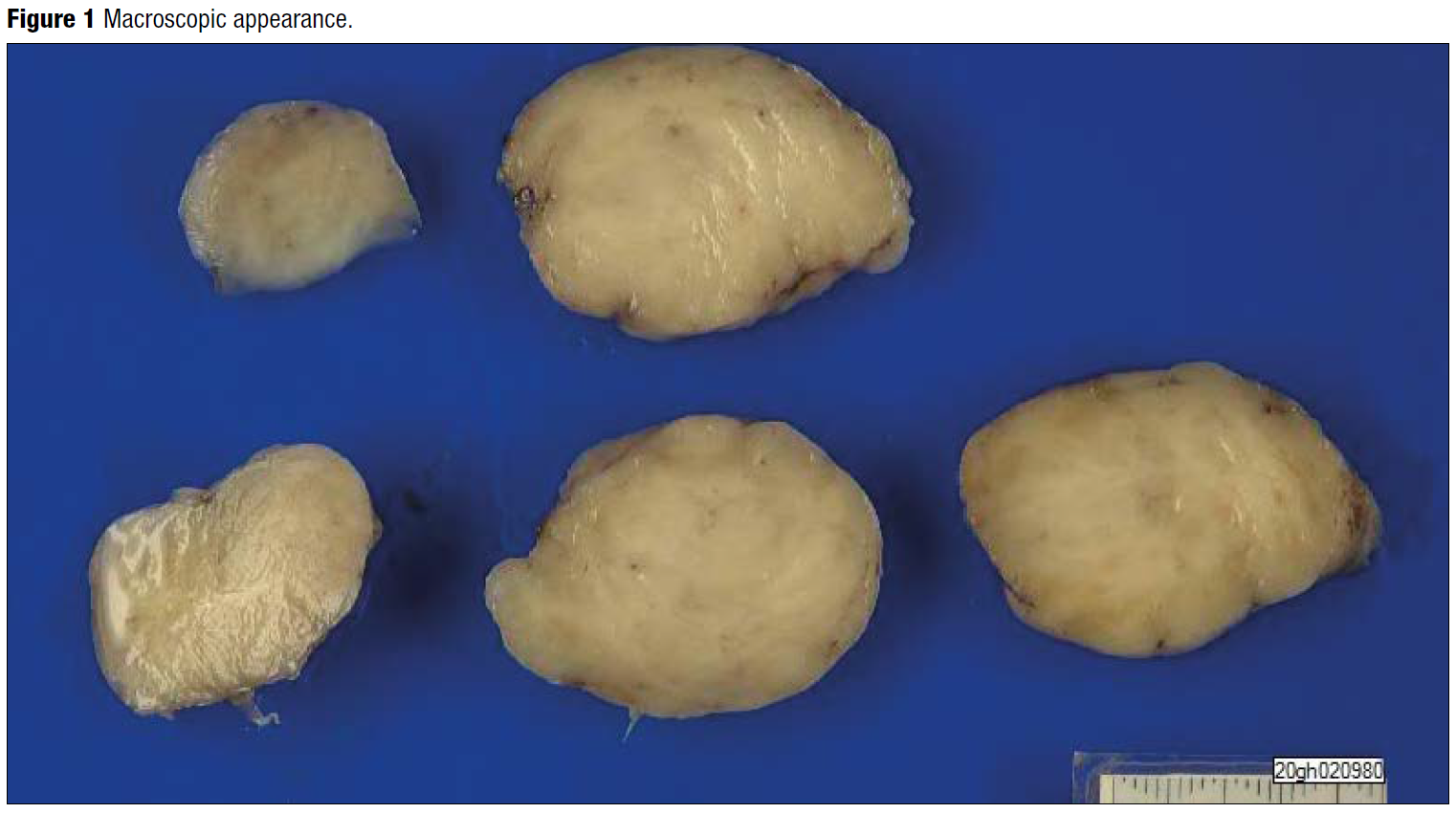 Inflammatory myofibroblastic tumor of the uterus – enucleation during C ...