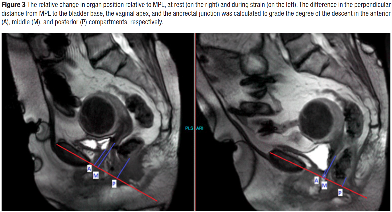 The association of MRI defined pelvic organ descent with urinary ...