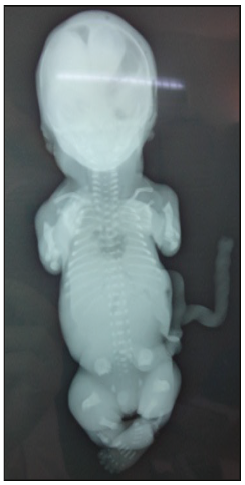 A comprehensive approach to diagnosing and managing a fetus with ...